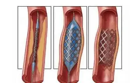 Spraying of medical stent coating