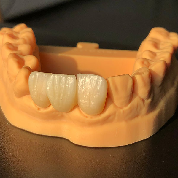 Zirconia Dental Block: Exploring Types & Translucency