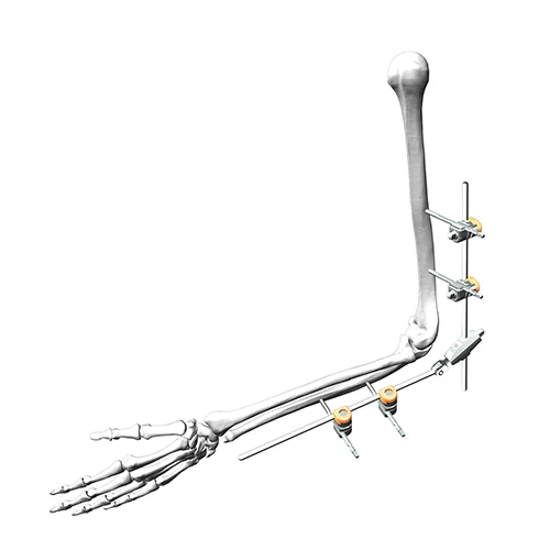 Cross Elbow Spanning External Hinged Movement Fixator Inature