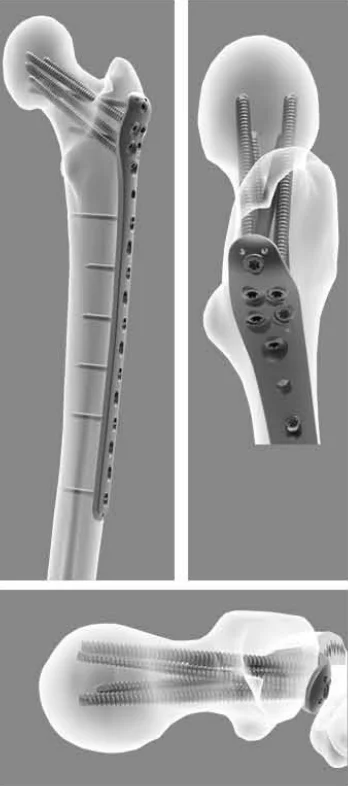 Proximal Femoral Locking Plate IV-| iNature - Manufacturer & Sale