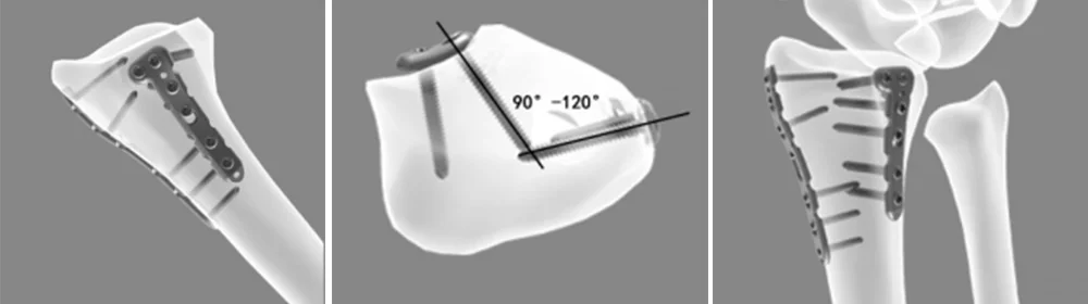 Distal Back Radius L-Type Locking Plate (Head 2 holes)-| iNature ...