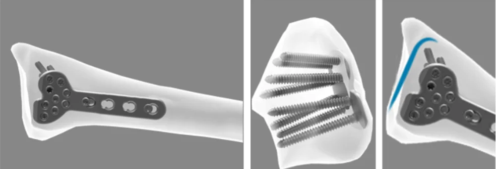 Distal Radius Volar Locking Plates I (Head 9 Holes)-| iNature ...
