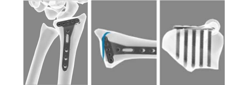 Distal Radius Volar Oblique Oblique T Locking Plate(Head 5 Holes ...