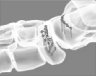 Foot Locking Plate System Manufacturer/Oem/For Sale-Inature