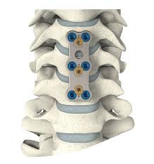 The Role of Spinal Plate Fixation in the Treatment of Spinal Infections