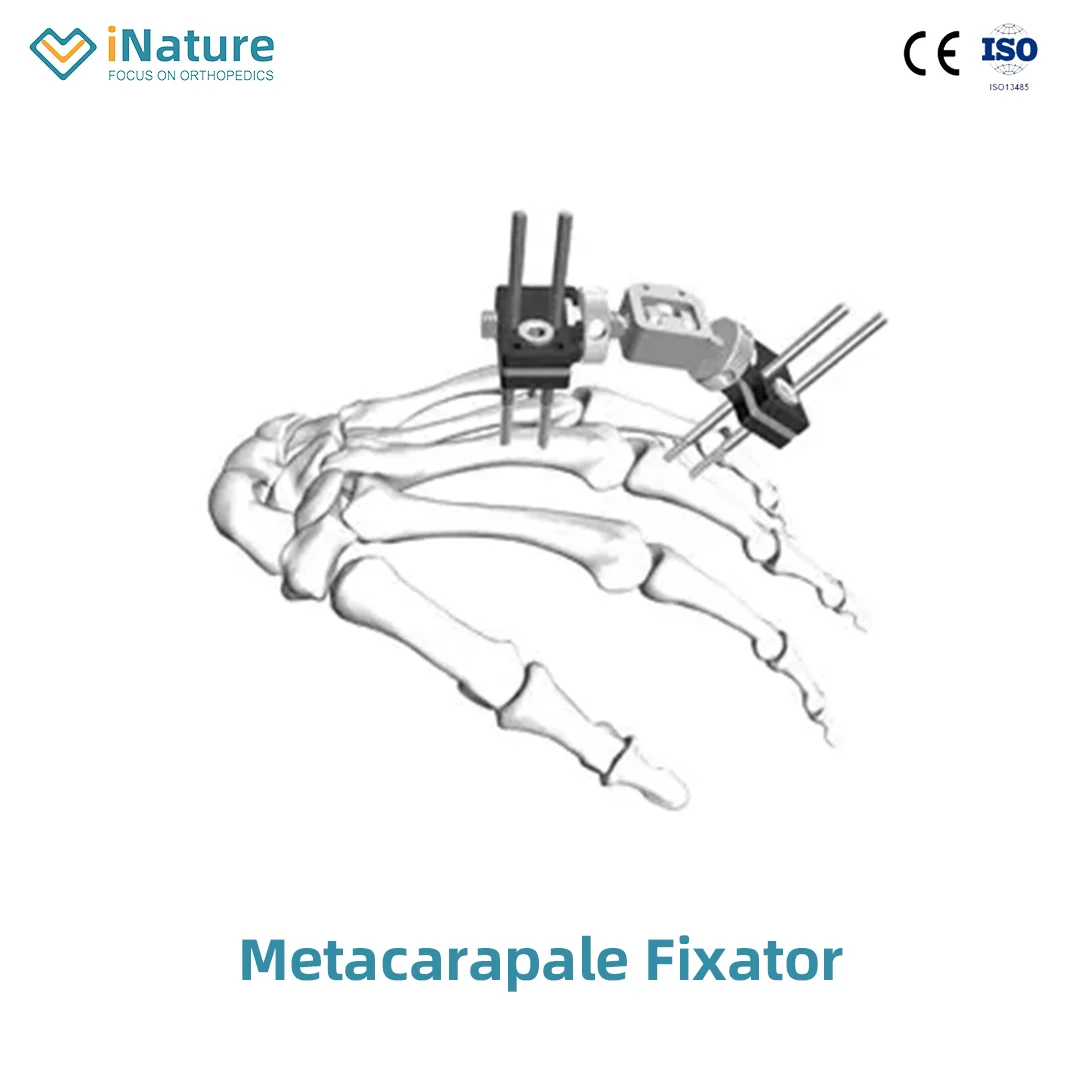 Wrist And Hand External Fixation Factory/Surgery-Inature